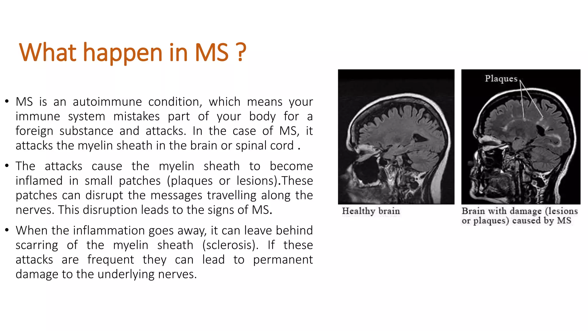 Multiple sclerosis pathophysiology, diagnosis, and treatment | PPTX