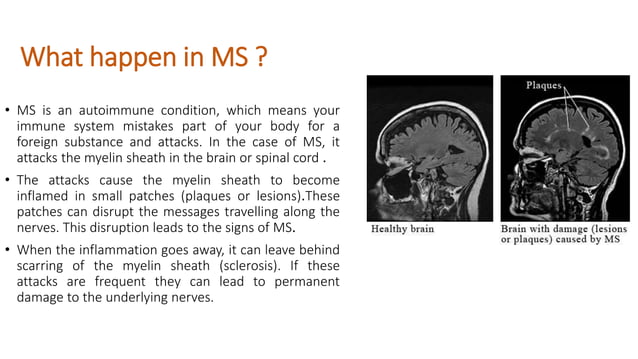 Multiple sclerosis pathophysiology, diagnosis, and treatment | PPTX