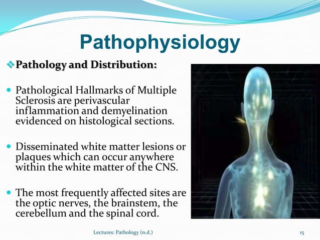 Multiple sclerosis adjusted to publish | PPT