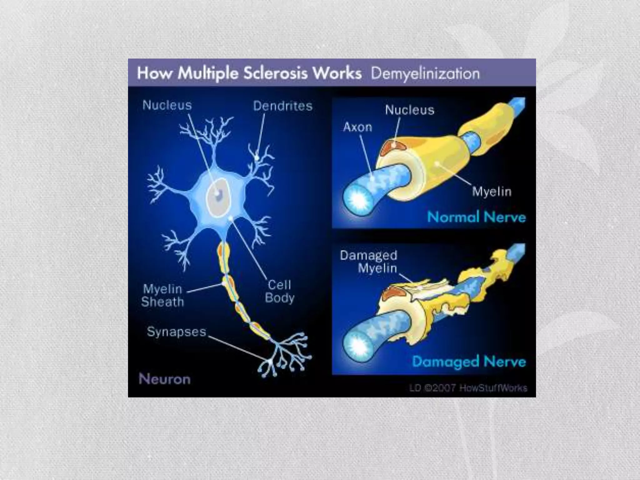 Multiple sclerosis a&p 2 project | PPT | Free Download