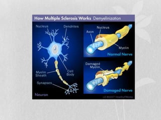 Multiple sclerosis a&p 2 project | PPT