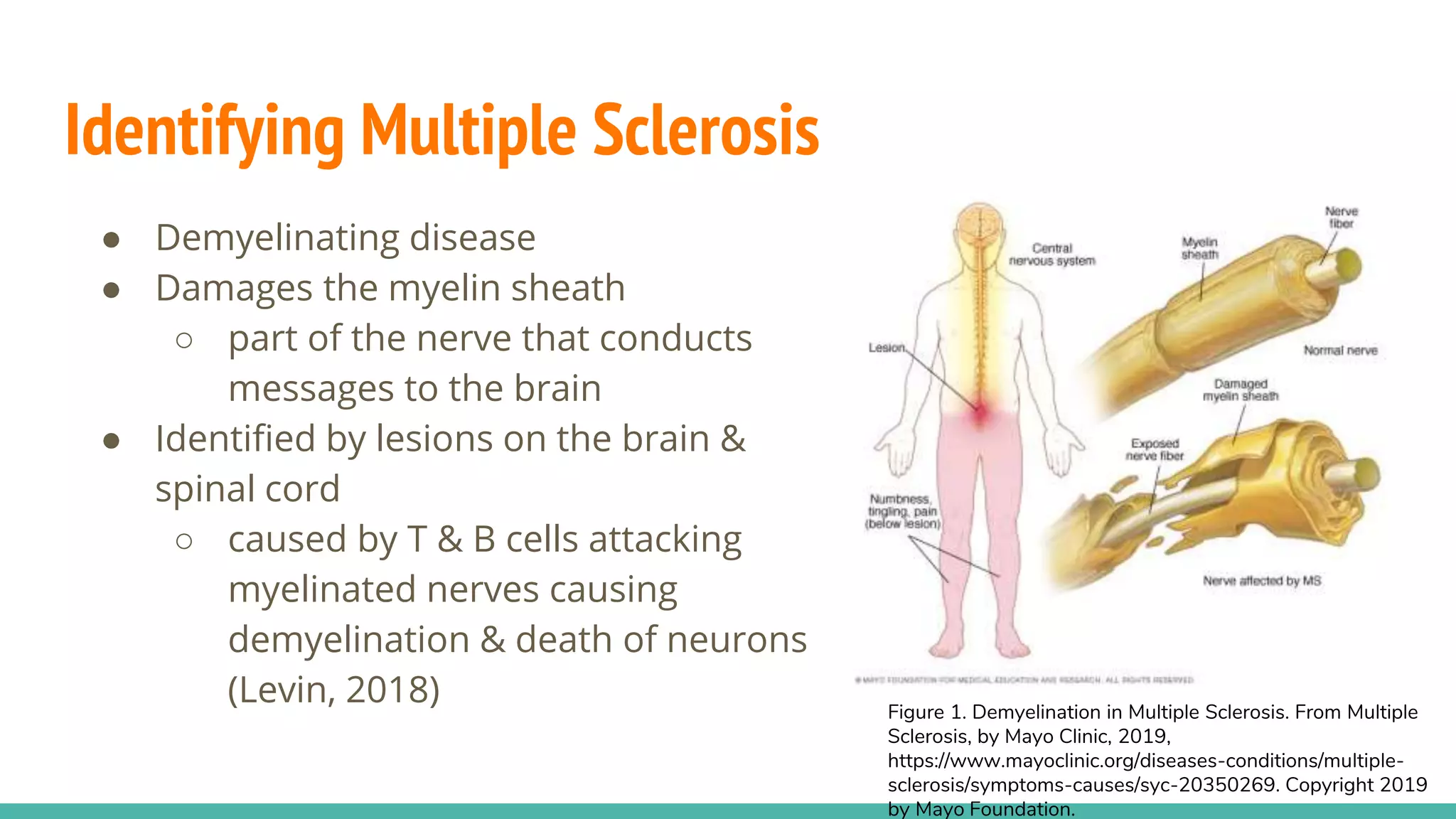 Multiple Sclerosis & Depression | PPTX