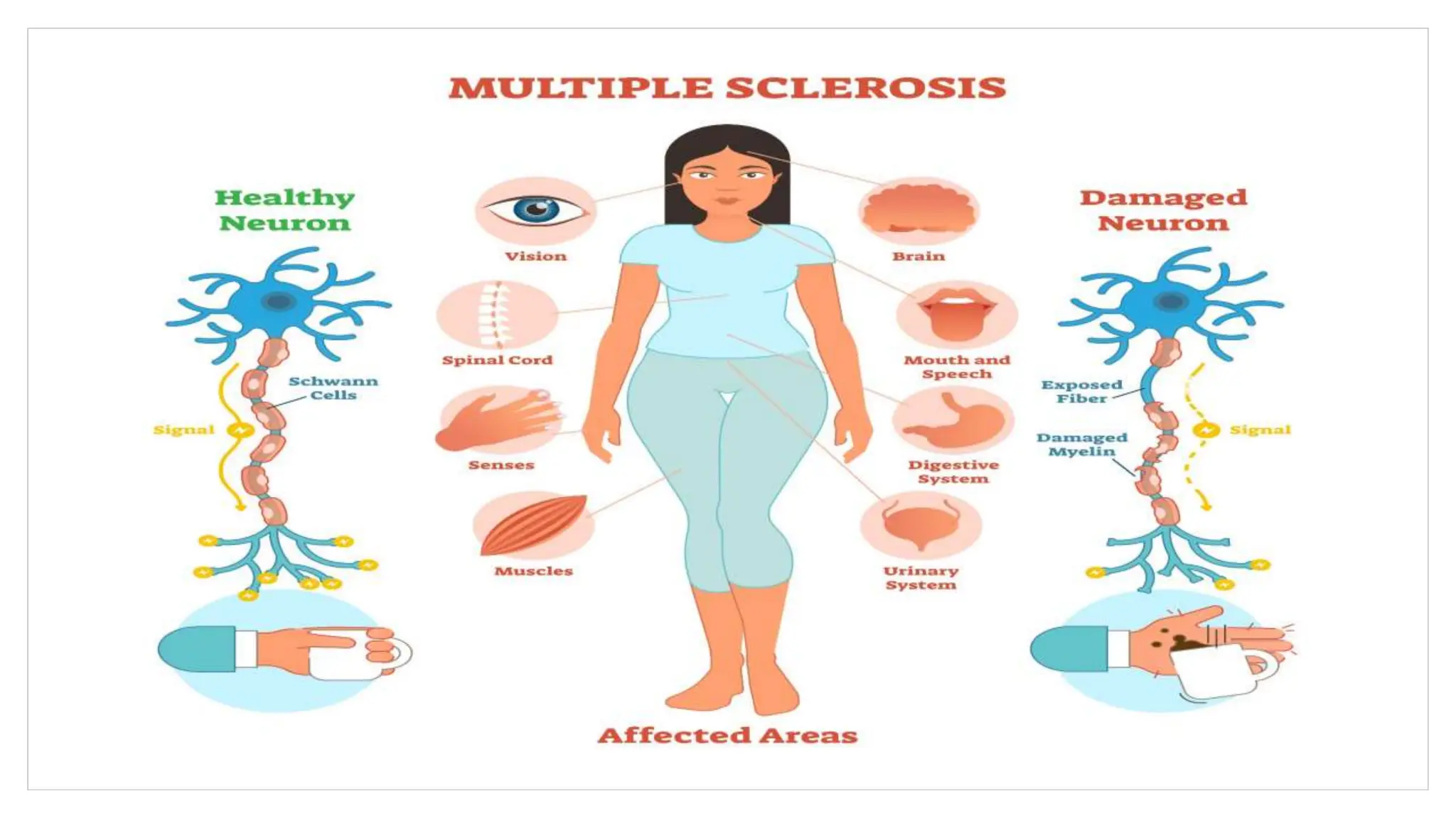 Multiple Sclerosis (Group 2).pptx . | PPTX | Brain and Nervous System Disorders | Diseases and ...