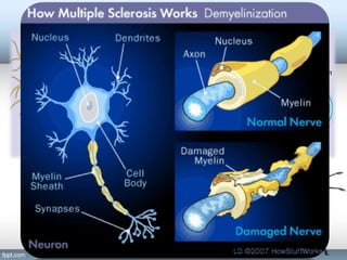 Multiple Sclerosis ppt | PPT
