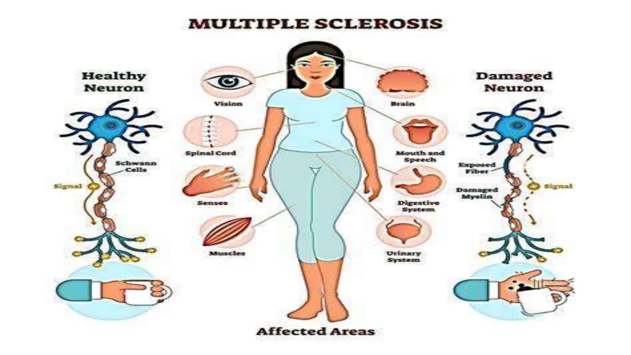 MULTIPLE SCLEROSIS PPT for nursing students.pptx