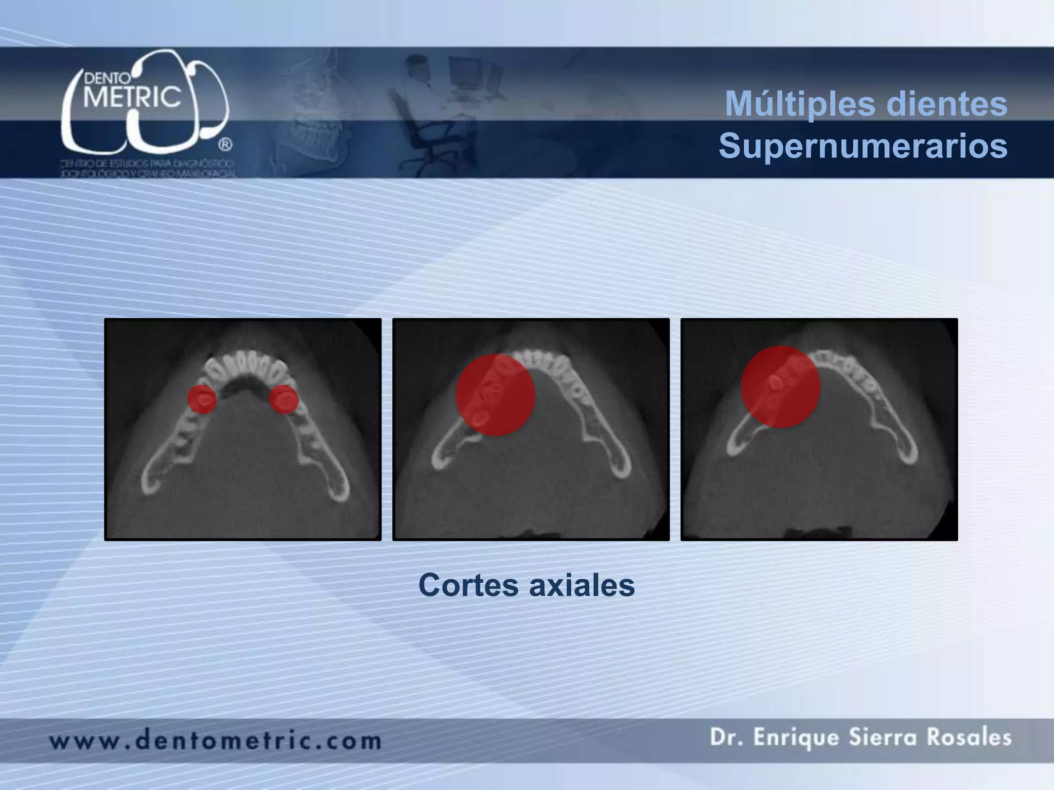 Multiples dientes supernumerarios | PPTX | Dental Health | Diseases and ...
