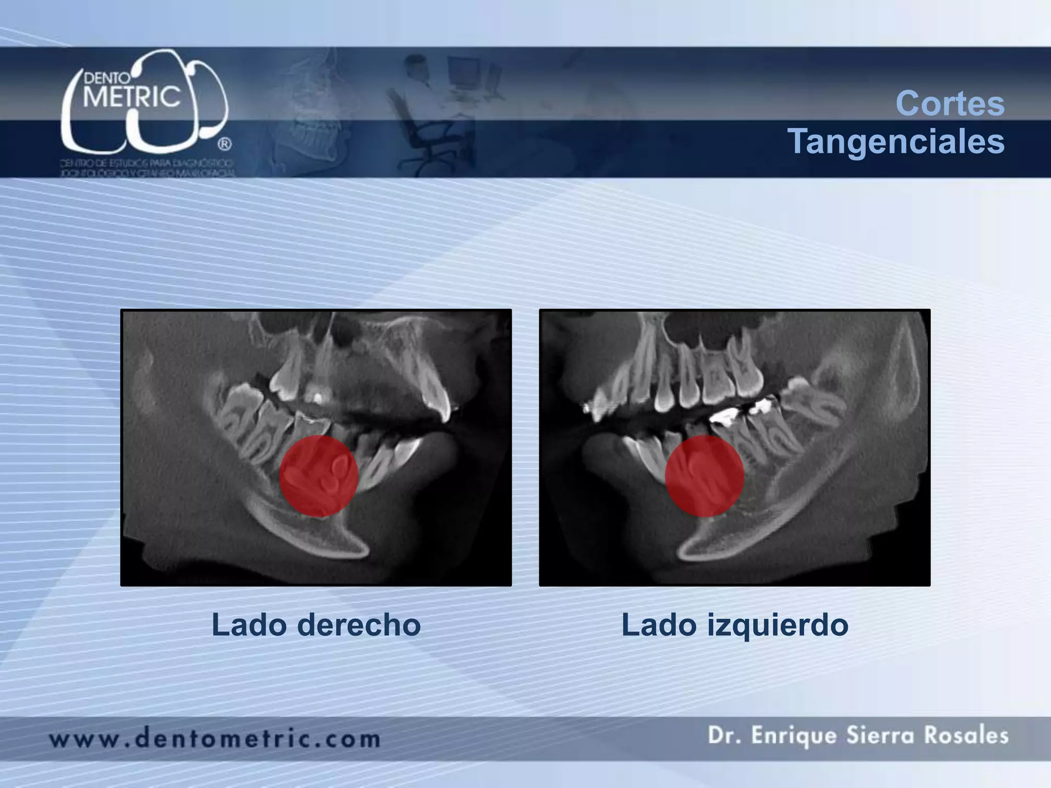 Multiples dientes supernumerarios | PPTX | Dental Health | Diseases and ...