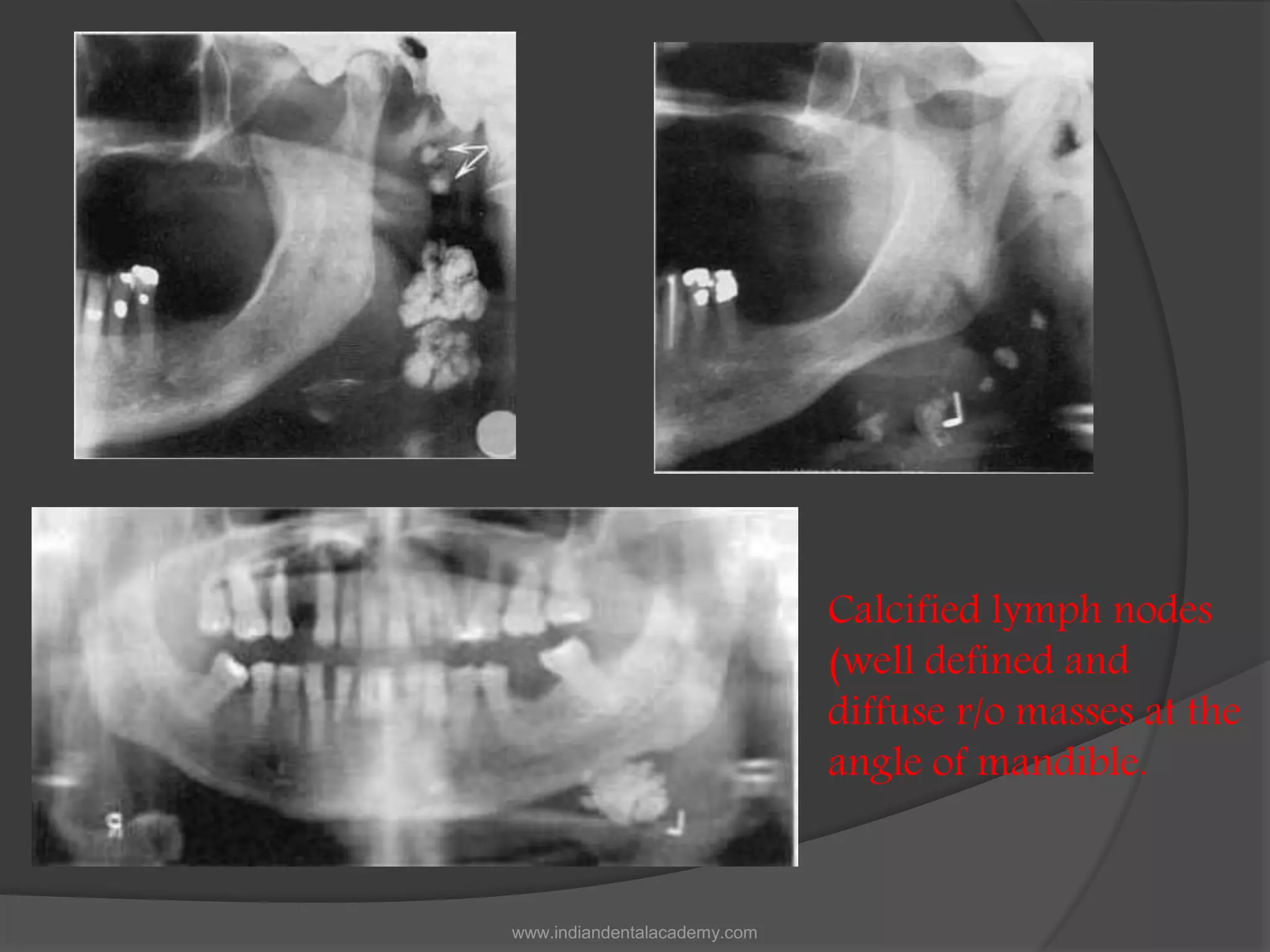 Multiple separate radiopacities /endodontic courses | PPTX
