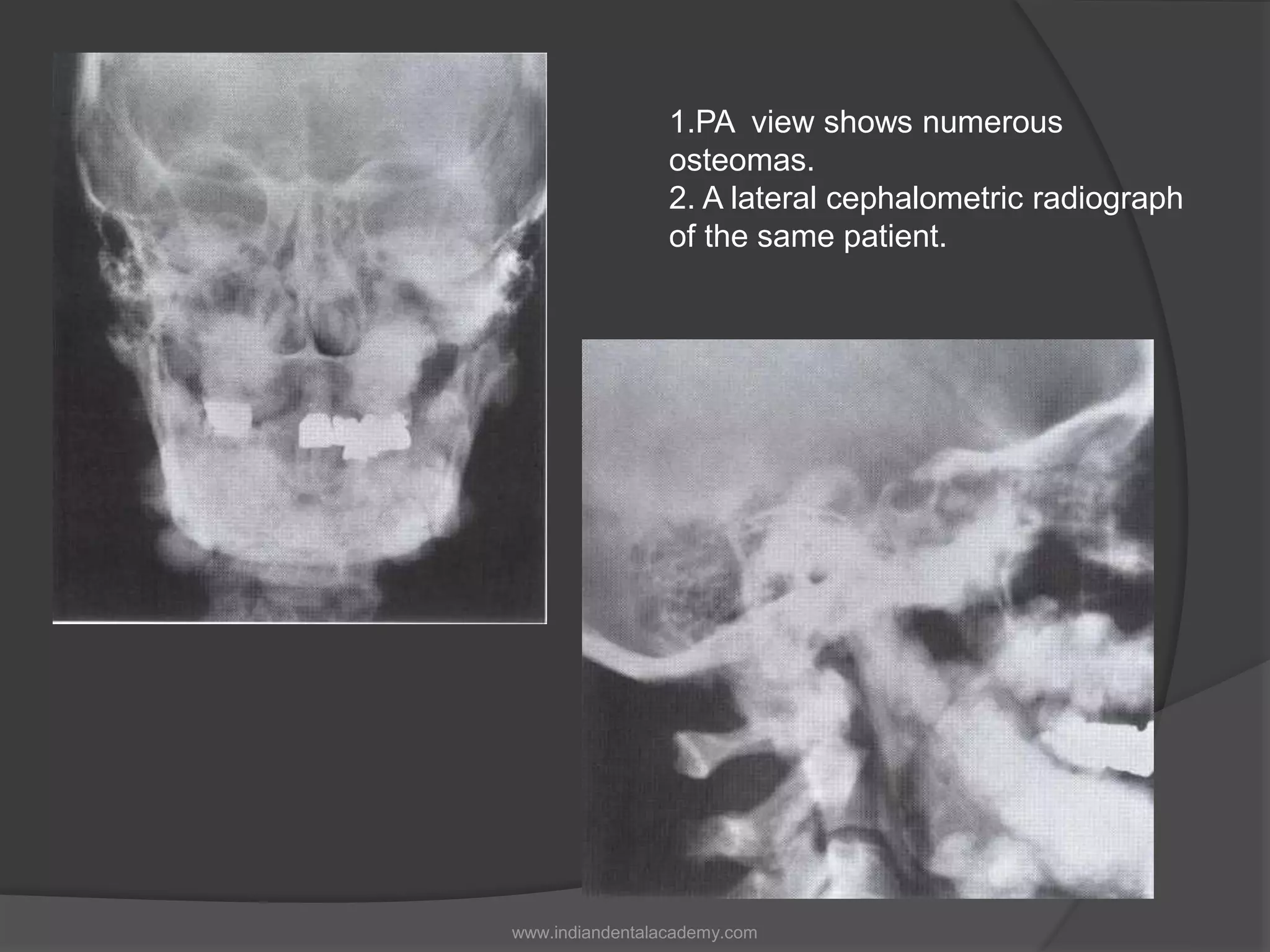 Multiple separate radiopacities /endodontic courses | PPTX