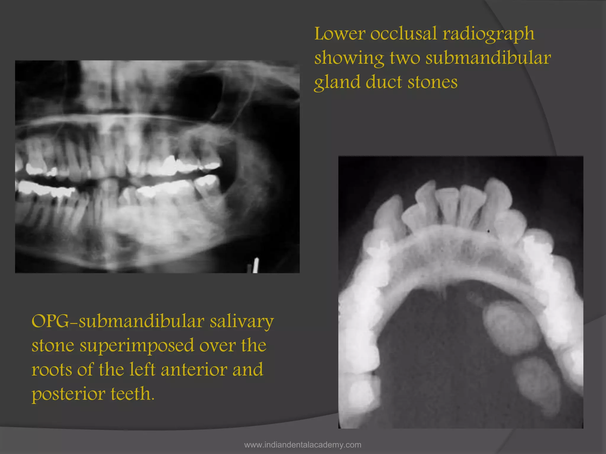 Multiple separate radiopacities /endodontic courses | PPTX