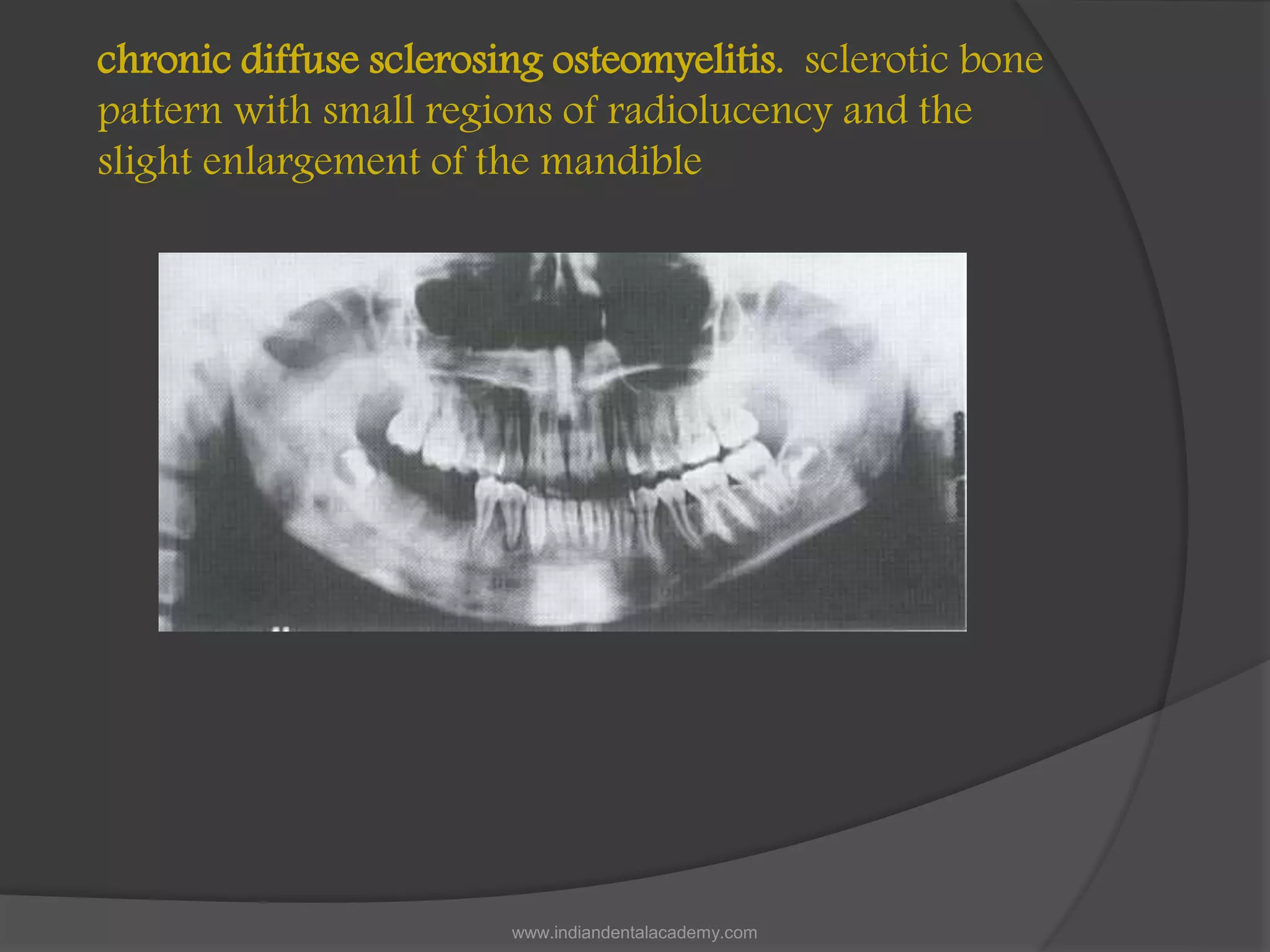 Multiple separate radiopacities /endodontic courses | PPTX