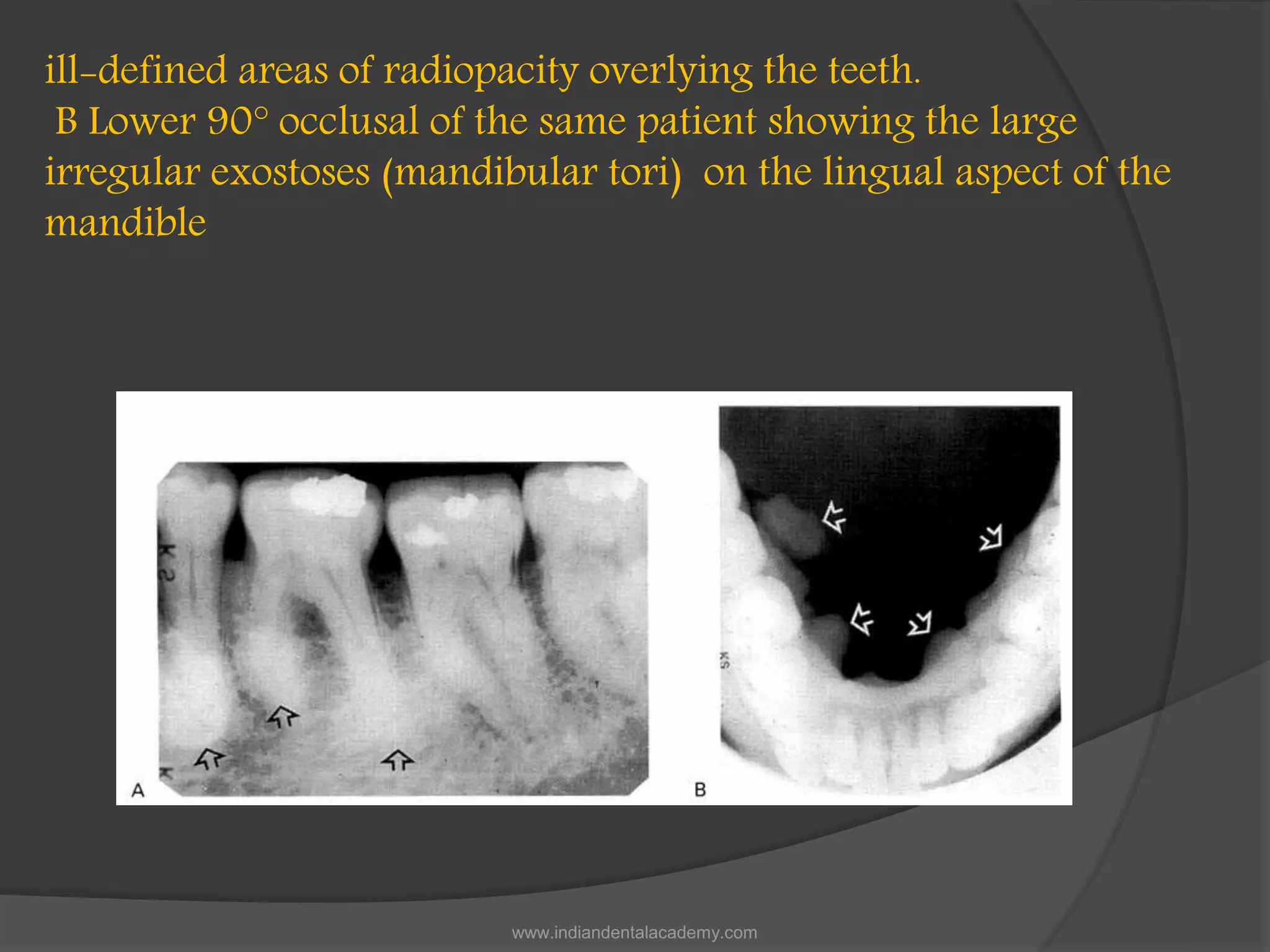 Multiple separate radiopacities /endodontic courses | PPTX