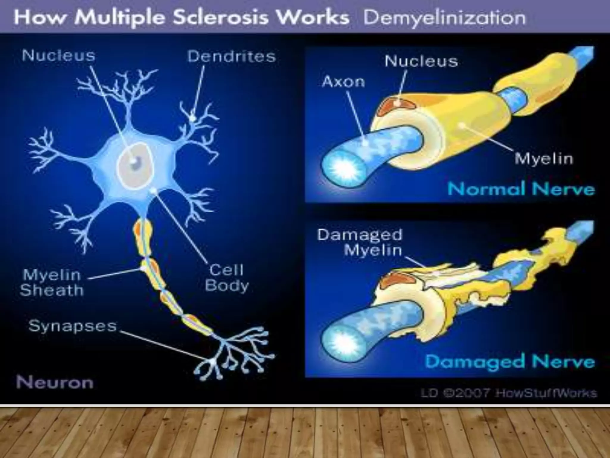 Multiple sclerosis (MS) | PPTX