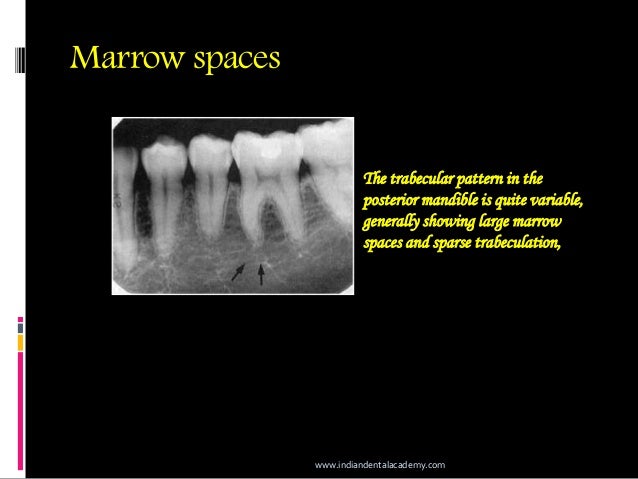 Multiple well defined radiolucencies / dental courses