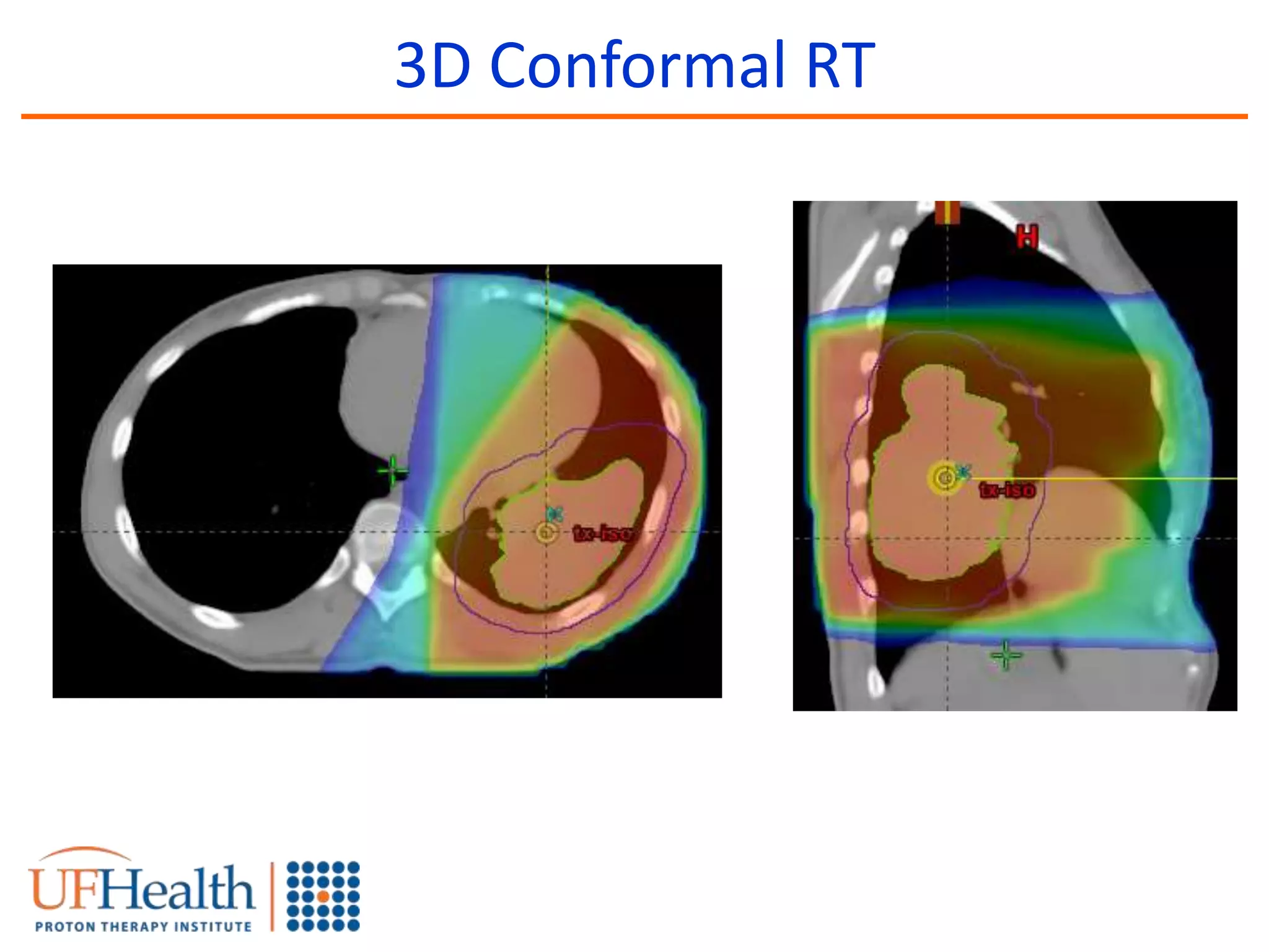Radiation Therapy in the Management of Lung Cancer | PPTX