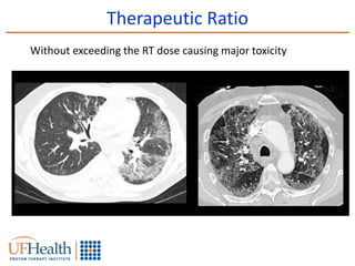 Radiation Therapy in the Management of Lung Cancer | PPTX