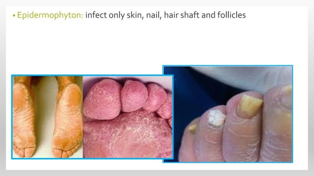 Superficial Mycoses Disease | PDF | Skin and Dermatology | Diseases and ...