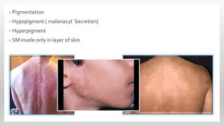Superficial Mycoses Disease | PDF | Skin and Dermatology | Diseases and ...