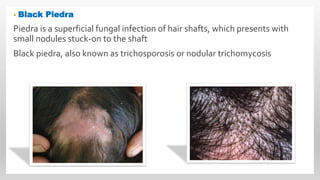 Superficial Mycoses Disease | PPT