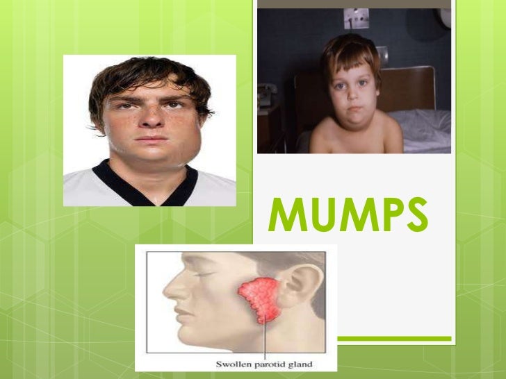 Mumps