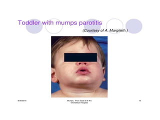 viral parotitis( MUMPS) | PPT