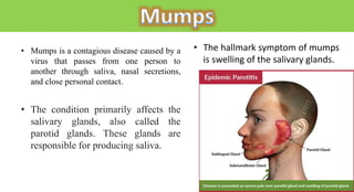 Mumps | PPTX | Ear, Nose and Throat Conditions | Diseases and Conditions