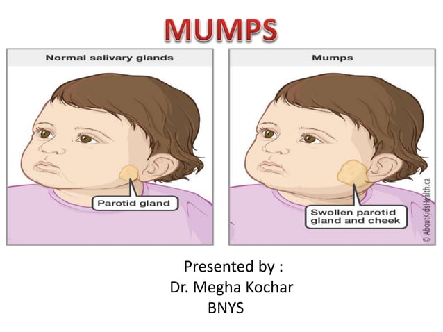 mumps.pptx