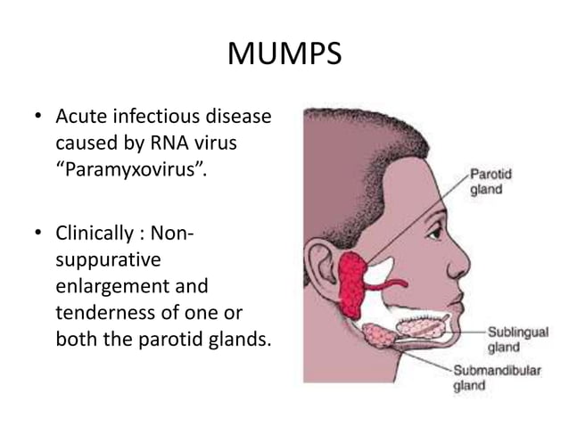 mumps.pptx