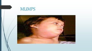 MUMPS.pptx