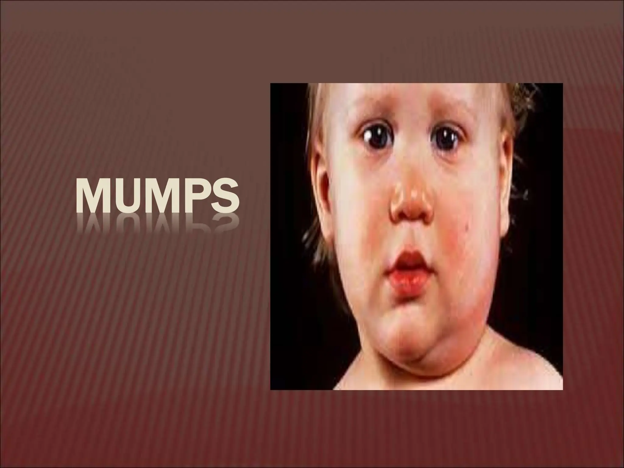 Mumps disease in community settings of IBD | PPT