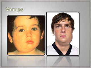Mumps report | PPTX