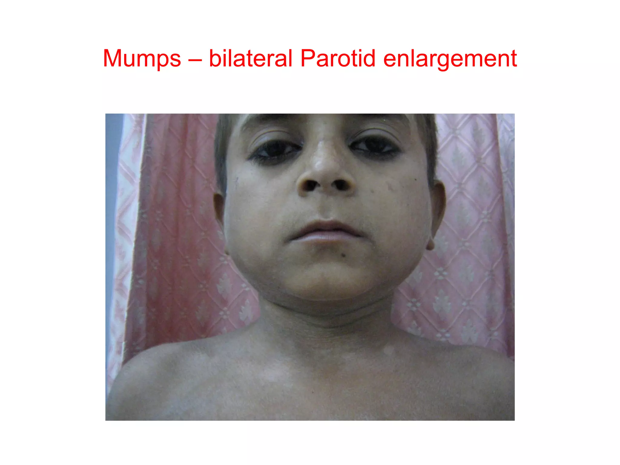 Mumps in children 2021 | PDF