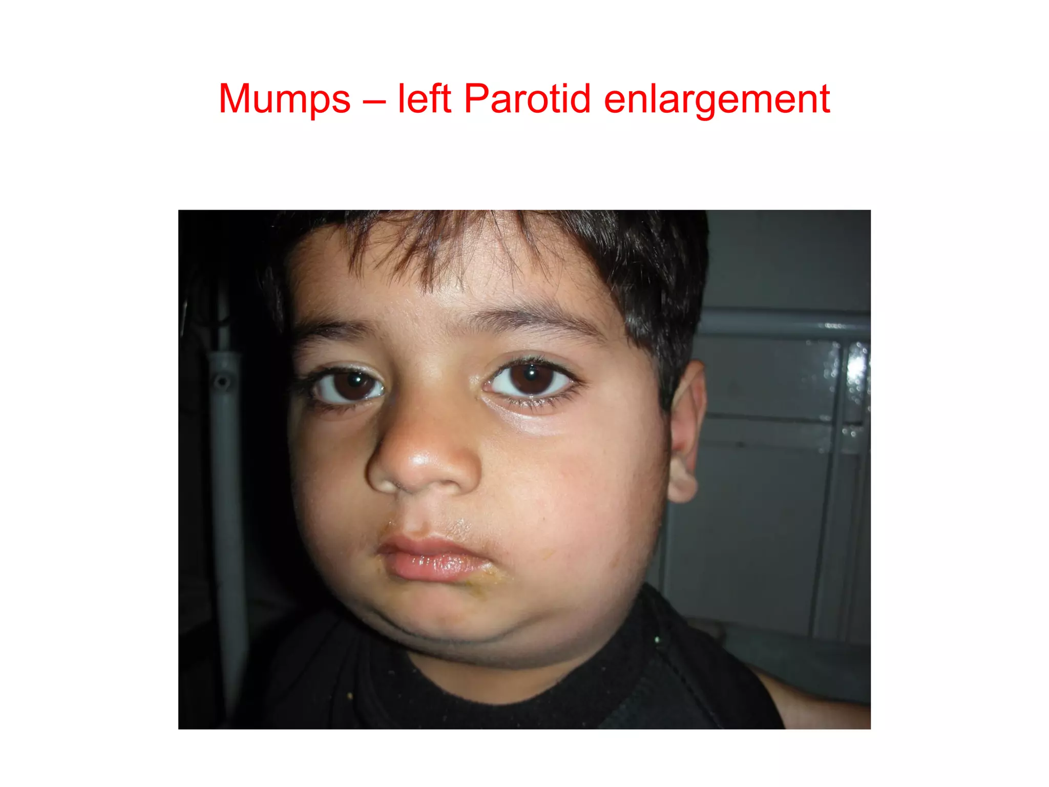 Mumps in children 2021 | PDF