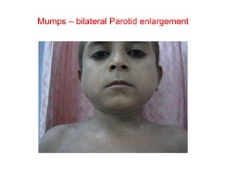 Mumps in children 2021 | PDF