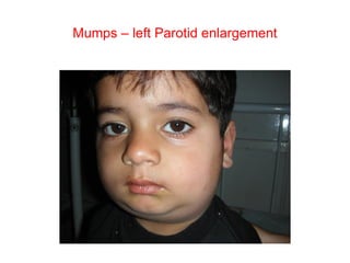 Mumps Pictures In Children