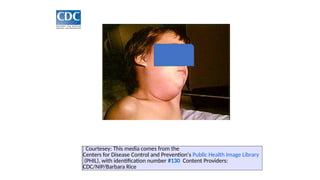 Mumps INTRODUCTION AND ITS EPIDEMIOLOGICAL STUDY | PPT
