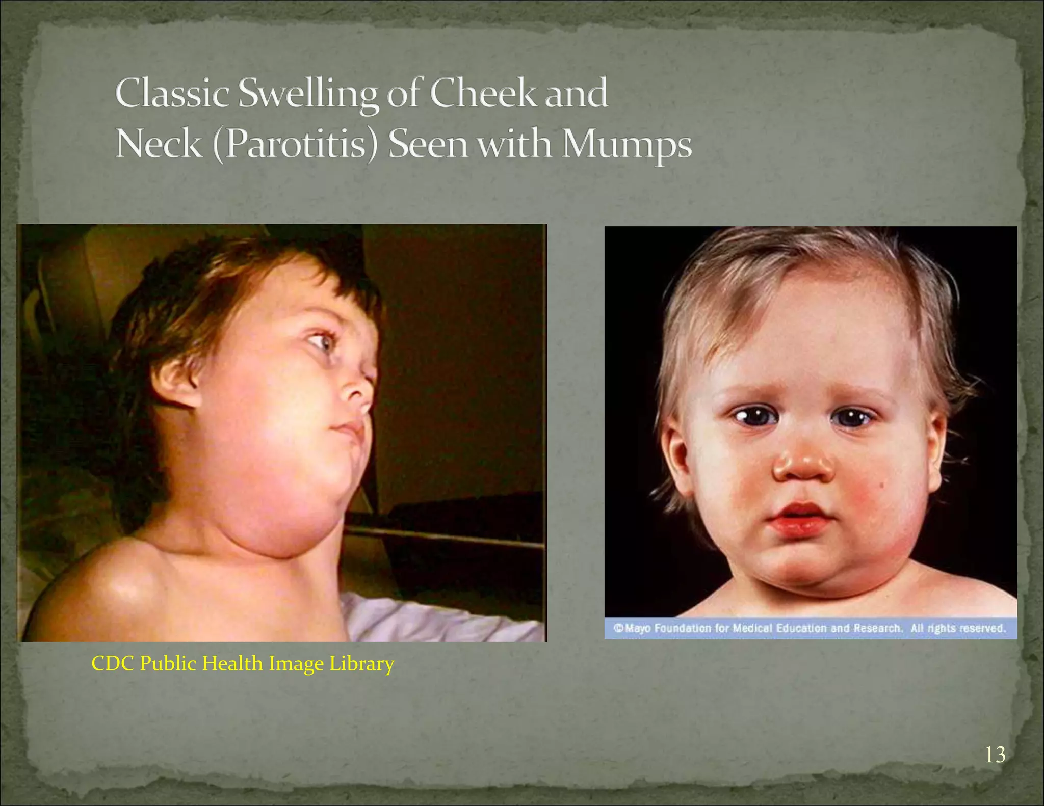 mumps ppt.ppt