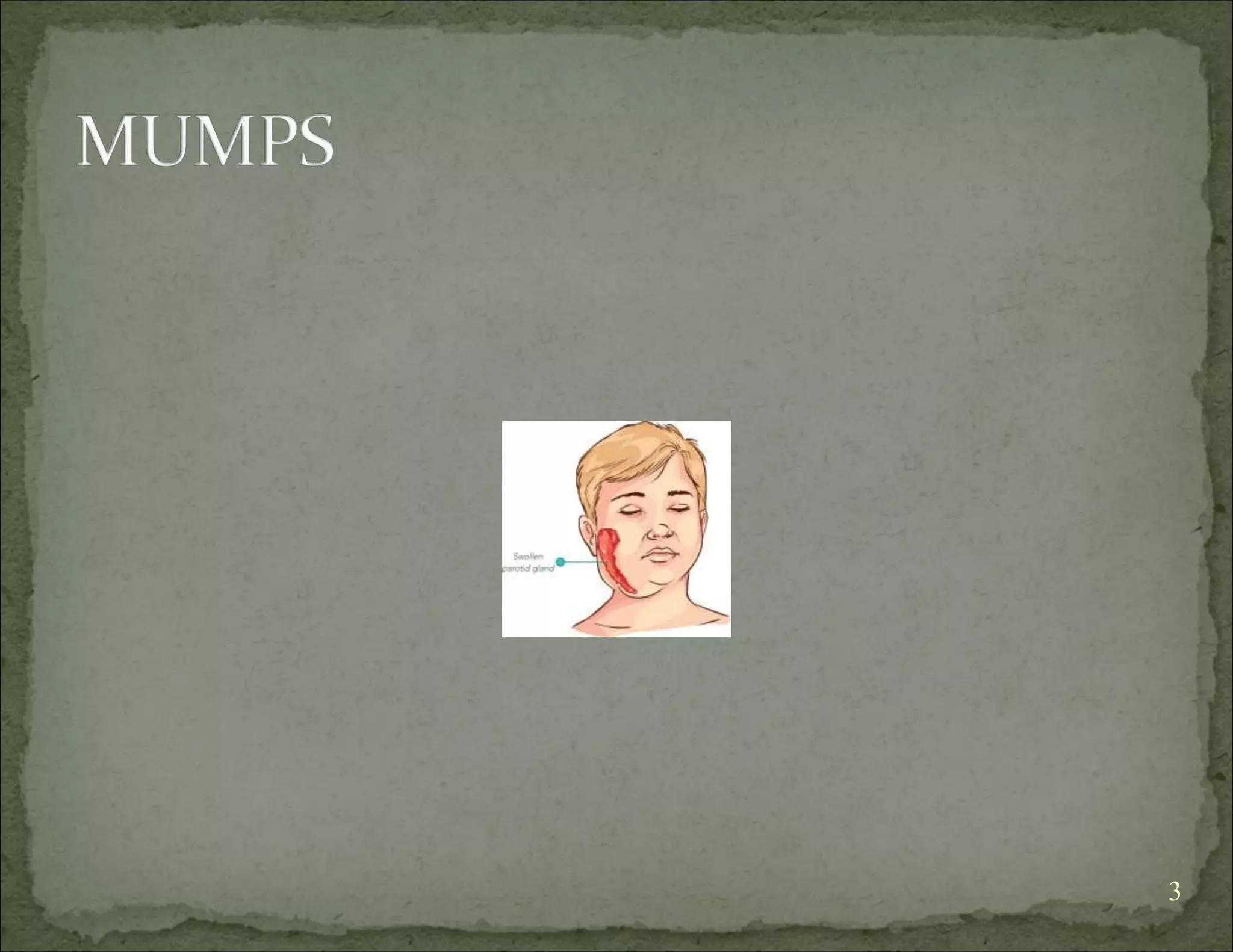 mumps ppt.ppt