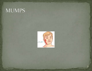 mumps ppt.ppt