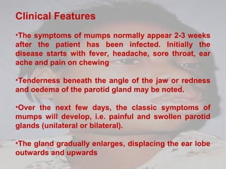 Mumps ppt biju | PPT