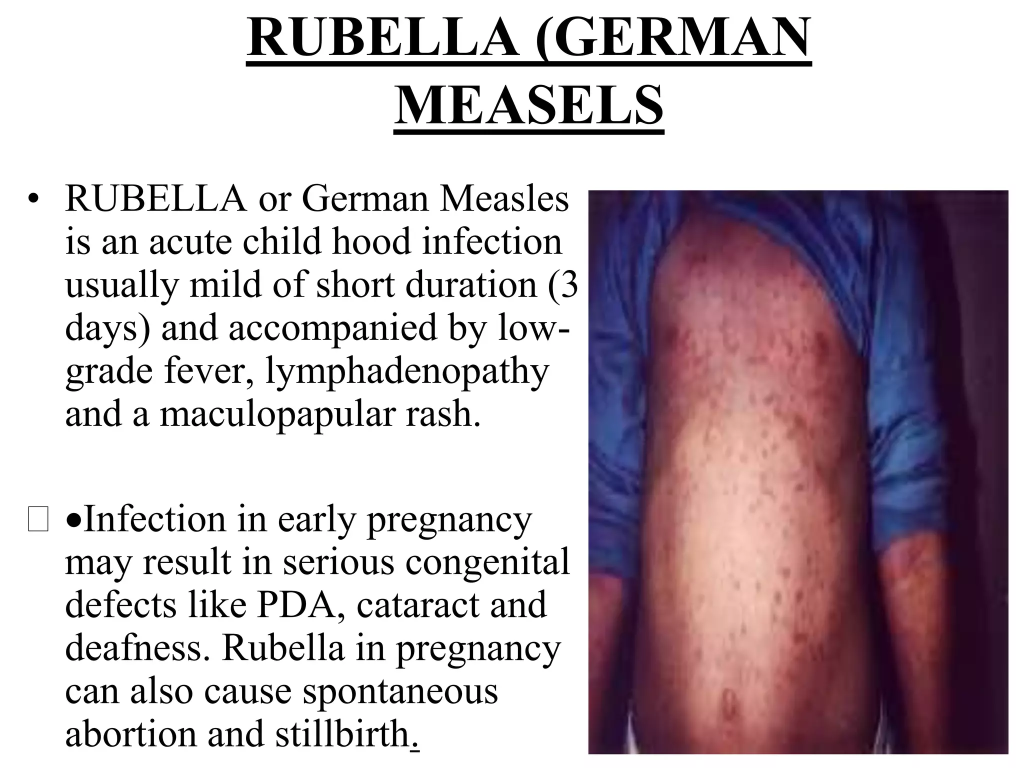 Mumps & Rubella.pptx