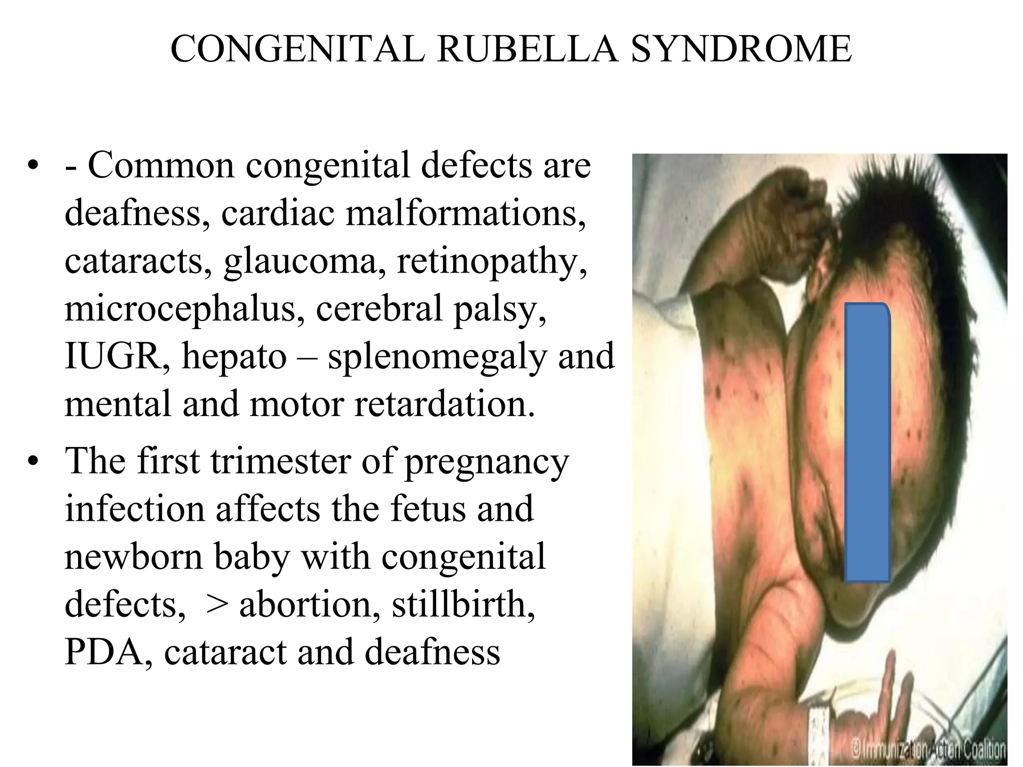 Mumps & Rubella.pptx