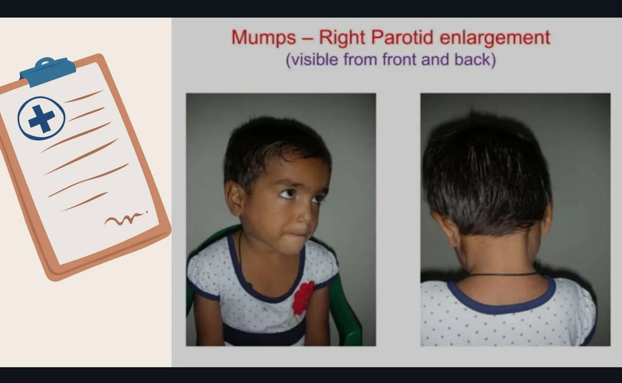 Mumps in children or epidemic parotitis) | PDF