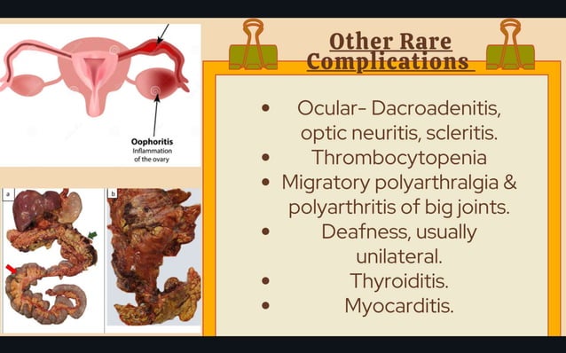 Mumps in children or epidemic parotitis) | PPT