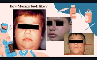 Mumps in children or epidemic parotitis) | PDF