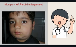 Mumps in children or epidemic parotitis) | PDF