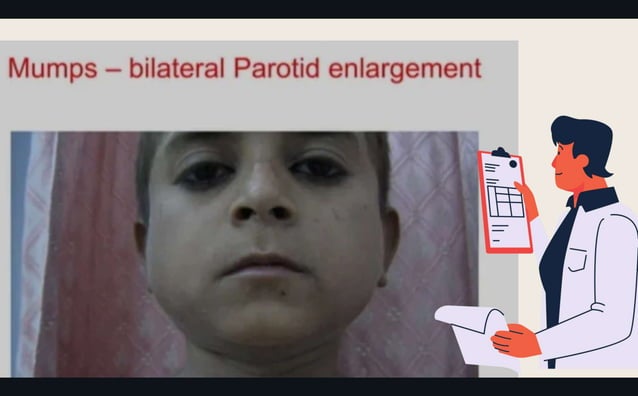 Mumps in children or epidemic parotitis) | PPT | Free Download