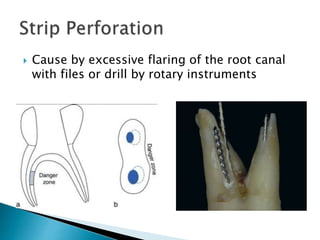 strip perforation | PPT
