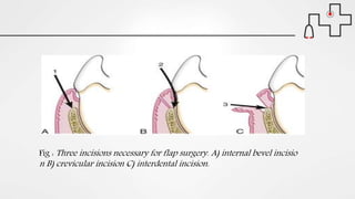 Flap surgery | PPTX