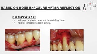 Flap surgery | PPTX